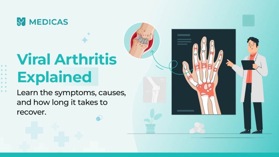 What Is Viral Arthritis? Symptoms, Treatment, and Recovery Time